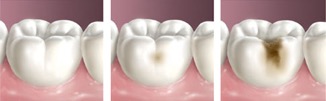 La carie dentaire - Centre de santé dentaire Al Dente à St-Jérôme